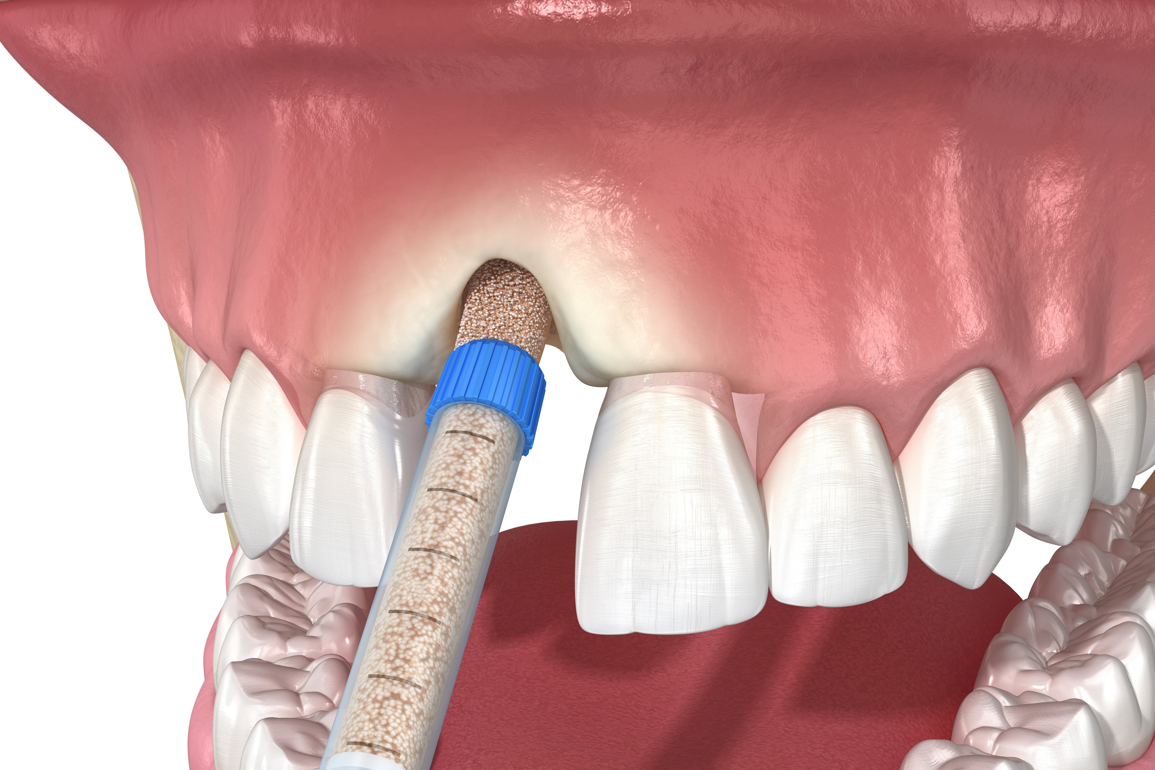 TBS Virtual Clinic: Simplifying Socket Preservation