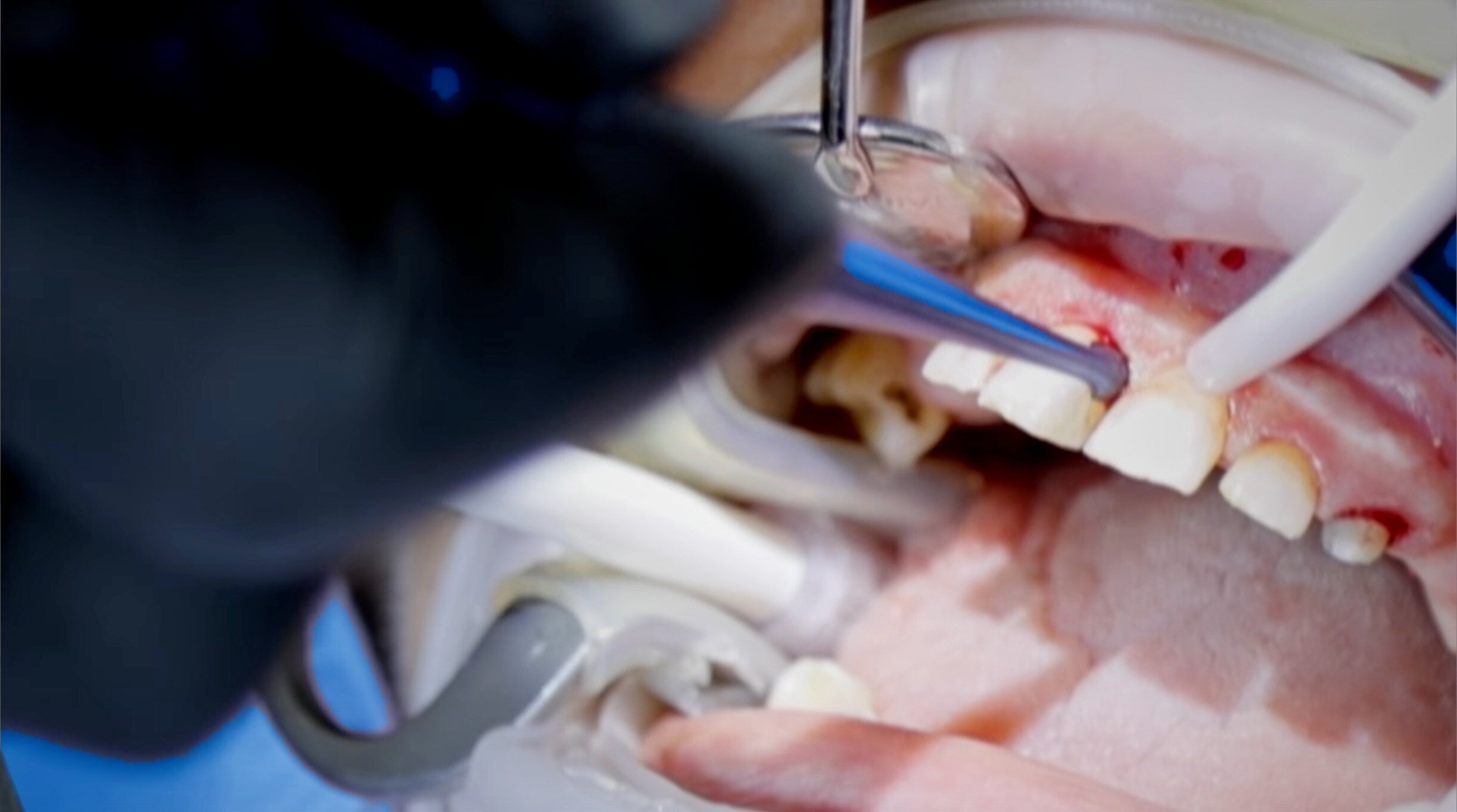 TBS Virtual Clinic: Minimally Traumatic Extractions